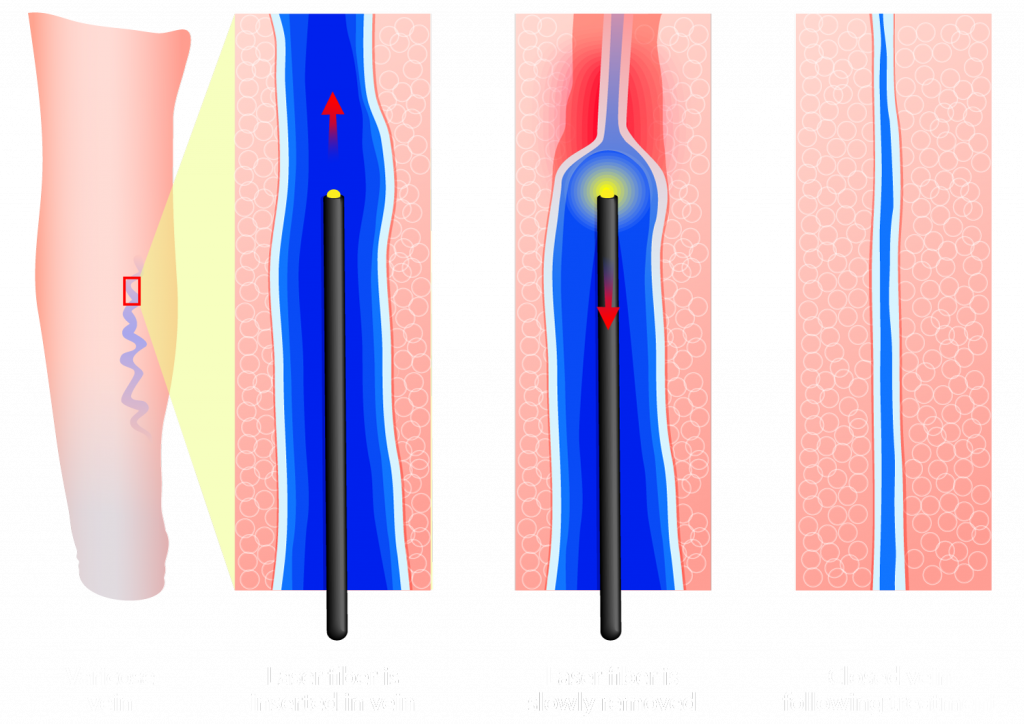 Endovenous laser Ablation | Varicose Vein Removal Treatment | Vein ...