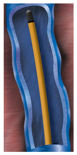 Radiofrequency Ablation RFA | Varicose Veins Treatment Sydney