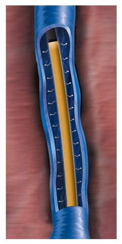 Radiofrequency Ablation RFA | Varicose Veins Treatment Sydney